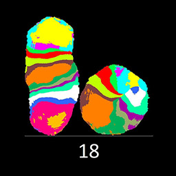 mBAND - Multicolor Banding Probes | MetaSystems Probes